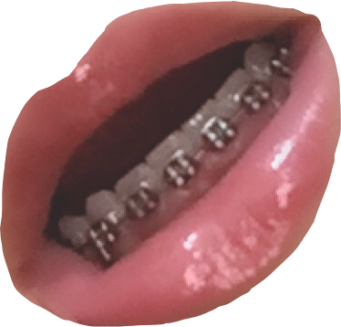 Glossy Lips With Braces | Lipstutorial.org